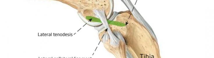 lateral-tenodesis-balalla - Dr. Bu Balalla