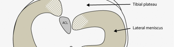meniscus-root - Dr. Bu Balalla